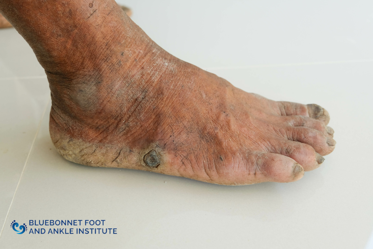 Diabetic Foot Syndrome - Bluebonnet Foot and Ankle Institute